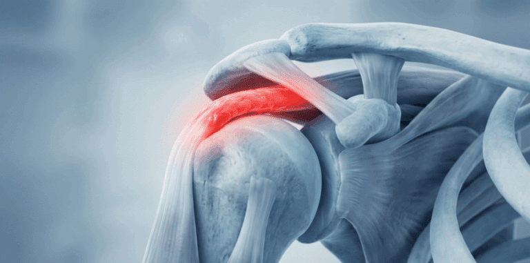 Shoulder Impingement Syndrome: Causes, Symptoms & Treatment - City ...