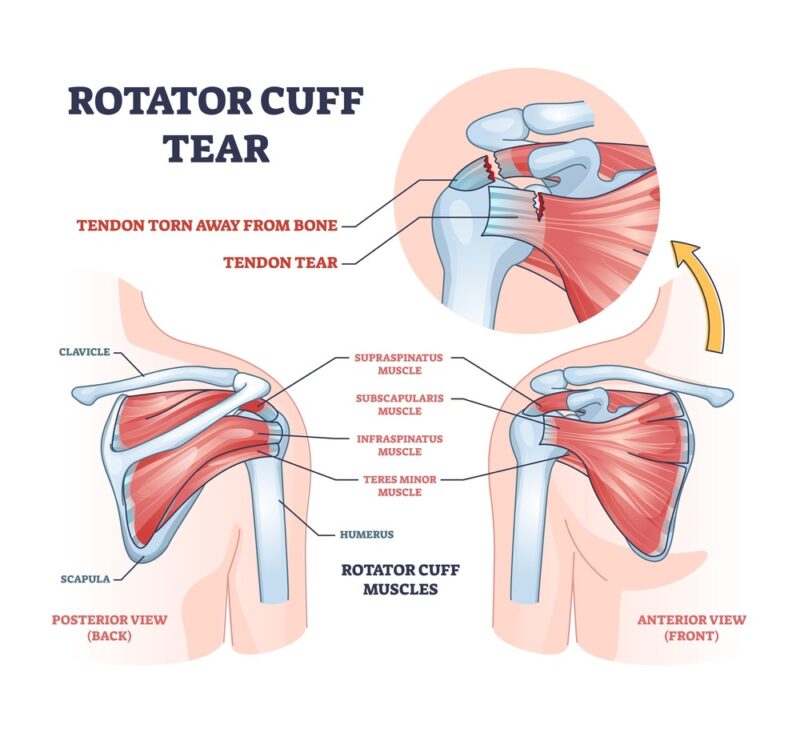 Rotator Cuff Surgery: Techniques, Recovery & Expectations - City ...